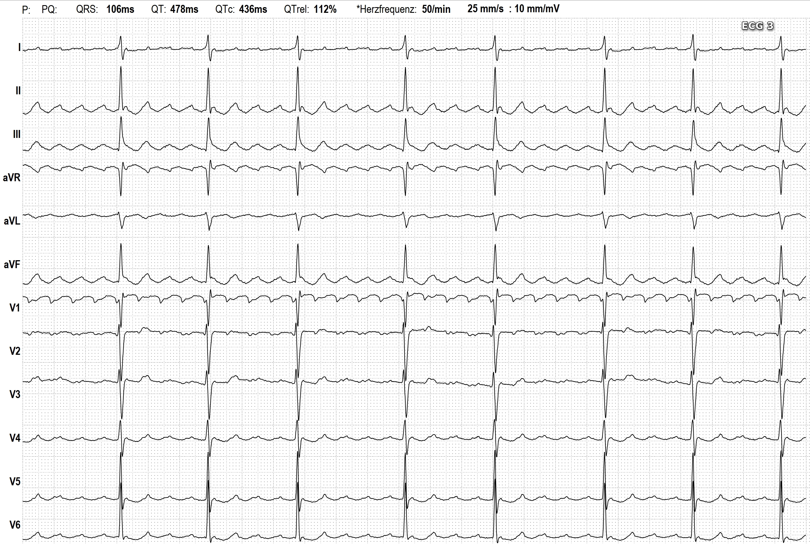 Atypical Atrial Flutter Ecg Guru Instructor Resources